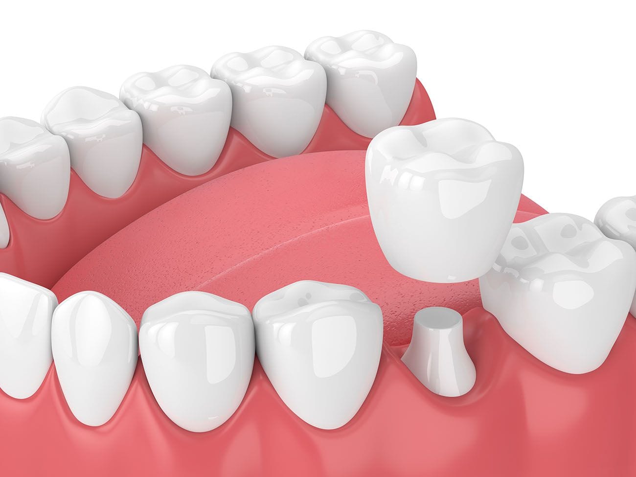 All About Dental Crown Procedures in Frederick, MD
